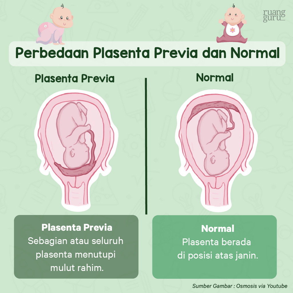 Mengenal Penyakit Plasenta Previa, dan Putri Ariani Penyanyi Theme Song Asian Para Games 2018